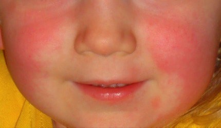 Rash after Fever in Children